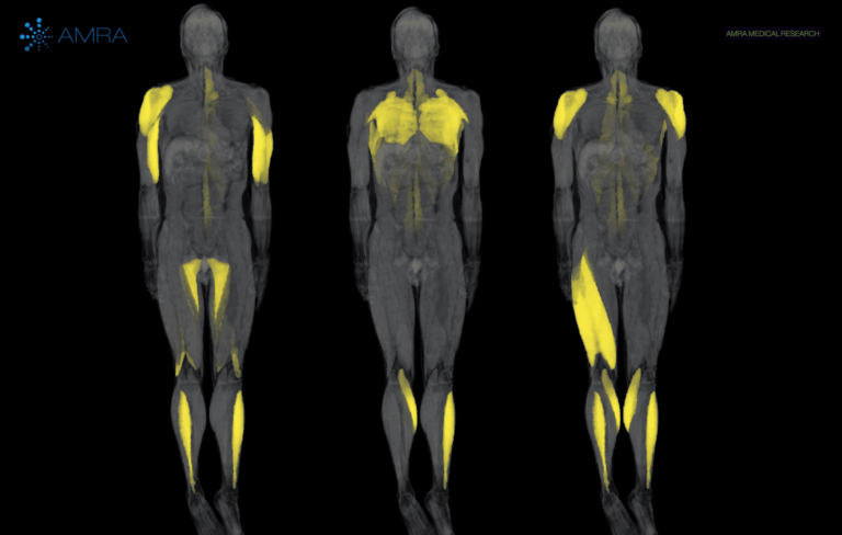 Fulcrum Phase 3 FSHD Clinical Trial Using AMRA Medical’s Whole-body MRI ...