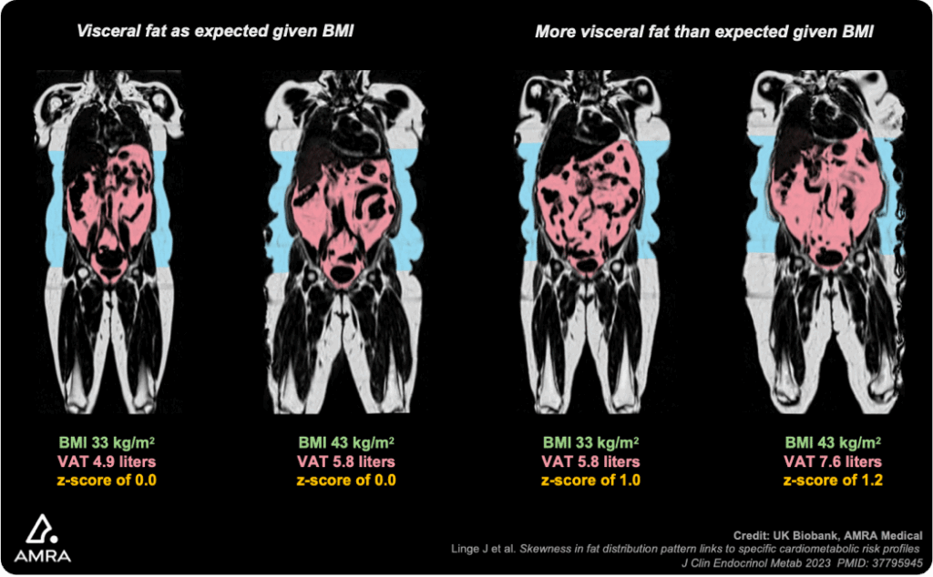 AMRA Medical Introduces Personalized Z-Scores for Weight Invariant Fat ...